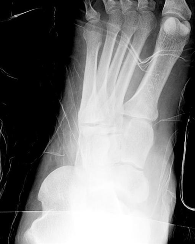 Subtalar Dislocations - Trauma - Orthobullets